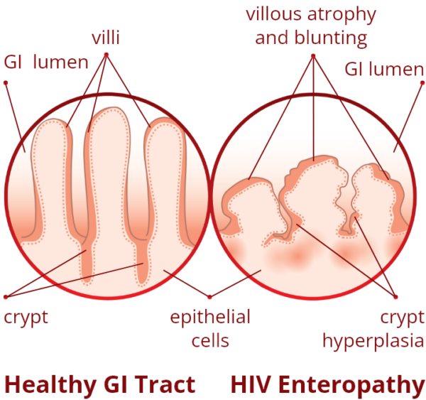 Noninfectious Diarrhea and Enteropathy - Mytesi HCP